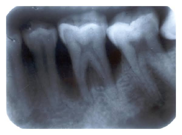 Aggressive Periodontitis - Dr Gourav Sharma Painless Treatments