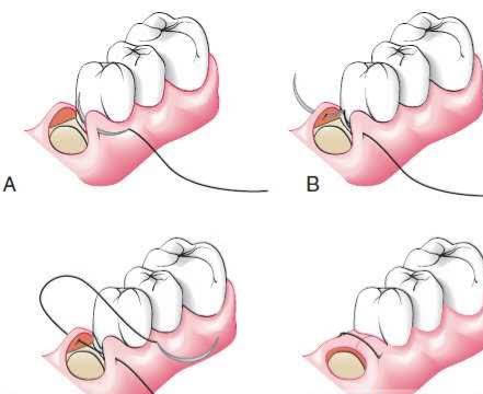 Periodontal Flap - Dr Gourav Sharma Painless Dental Treatments