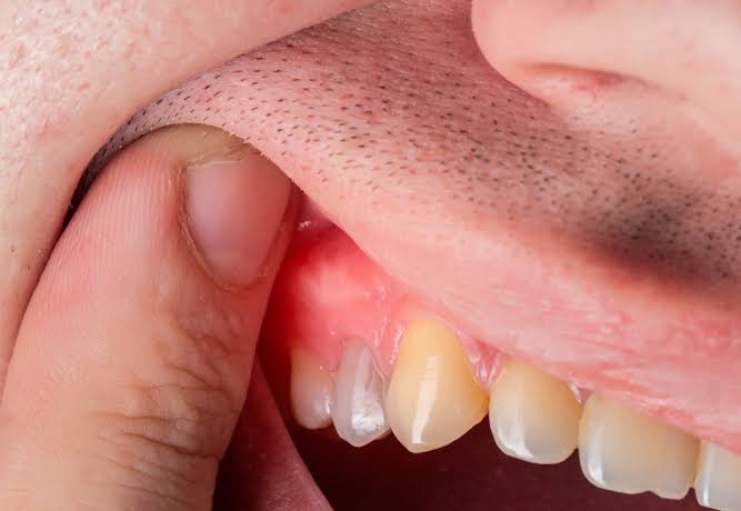 Dental Abscess - by Dr Gourav Sharma Painless Dentist Shivpuri M.P