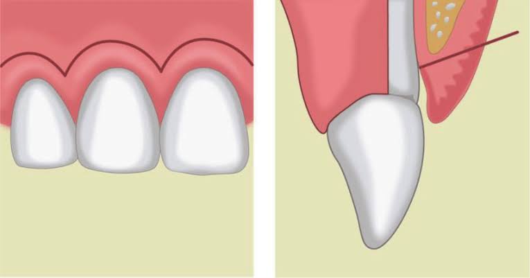 Modified Widman Flap - by Dr Gourav Sharma Best Painless Dentist Shivpuri