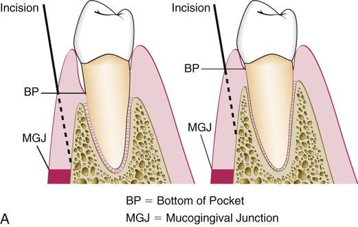Undisplaced Flap - by Dr Gourav Sharma Best Painless Dentist Shivpuri